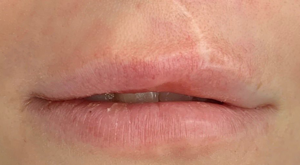 Lip Blush: Will it Disguise Scars or Pigmentation Loss? - Soy Ambar Studio